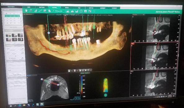 Computer Guided Implant Surgery- » The Premier Dentist Timonium MD
